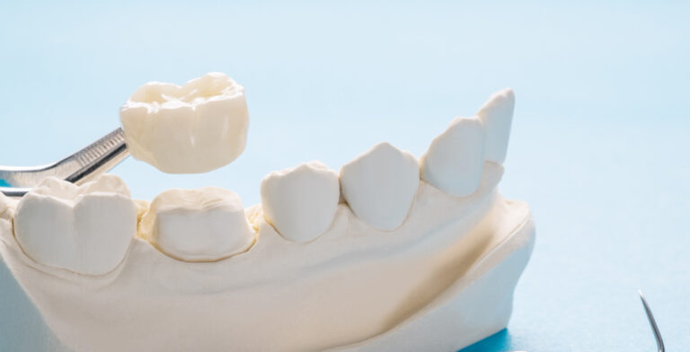 Crowns in Overland Park _ Kansas Family Dental